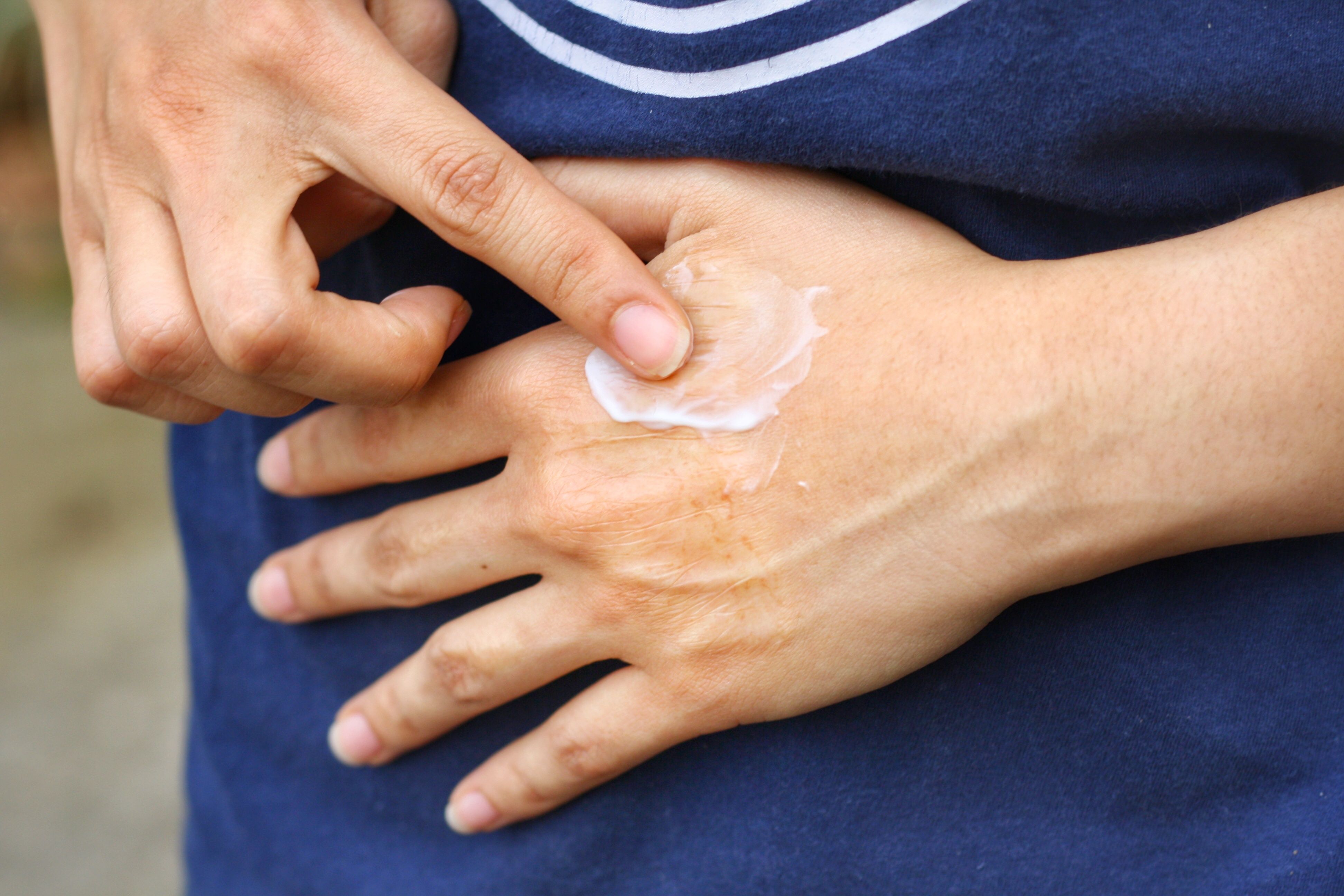 Expert Discusses Topical Analgesics as First-Line Treatment of Pain ...