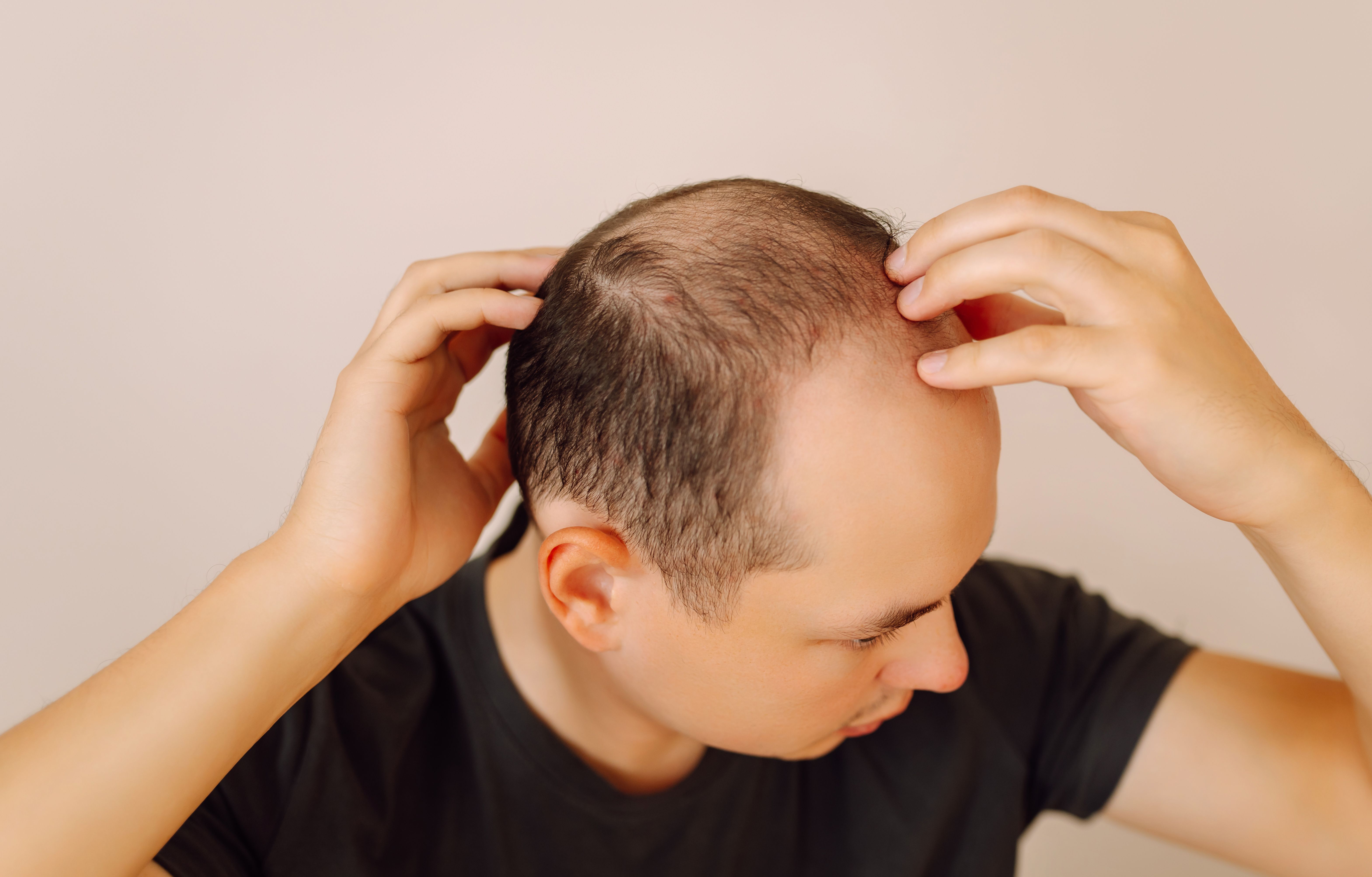 Hair Loss Therapy Shows Potential for Regeneration in Phase 2 Trial ...