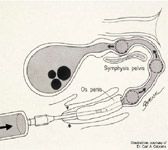 7 steps to perform retrograde urohydropropulsion