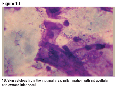 Topical triamcinolone and allergic dermatitis: A case study