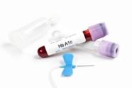 A1c Test Fails To Catch Most Diabetes Cases Endocrinology Network