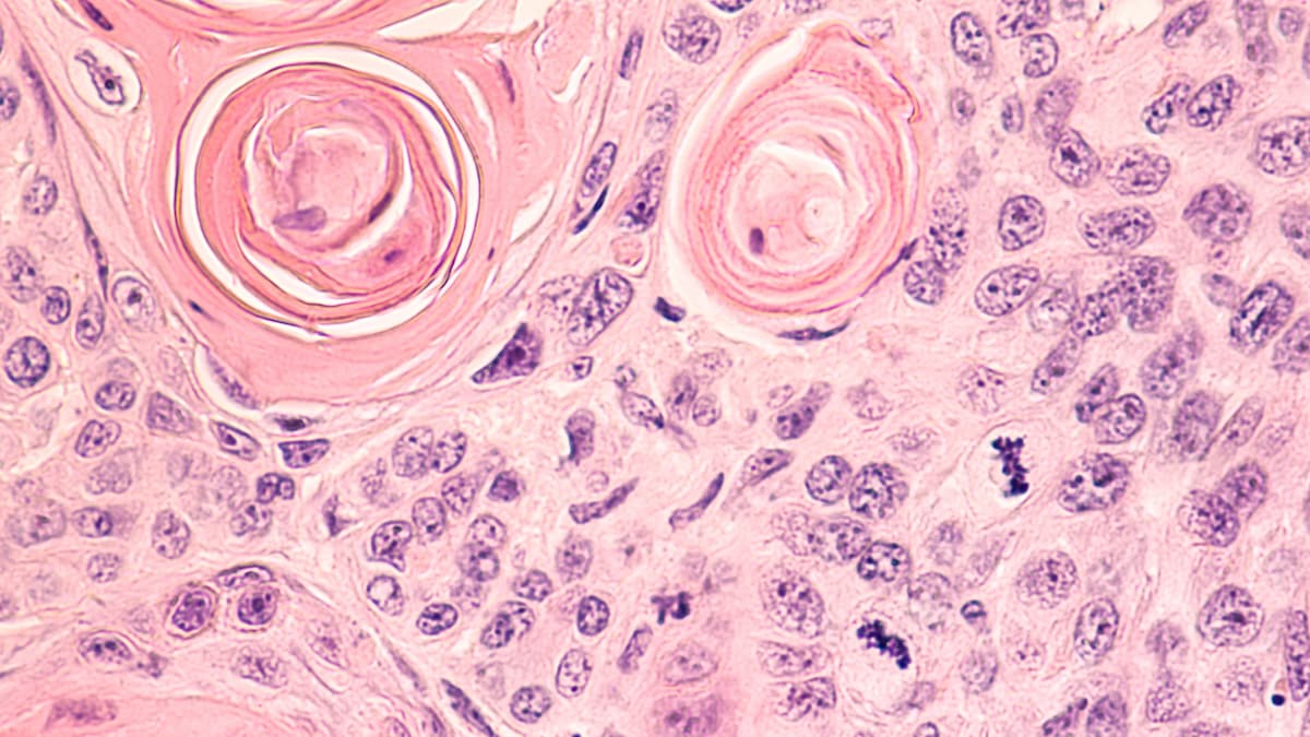 Tumor Infiltrating Lymphocyte Therapy LN-145 Achieves Responses Among ...