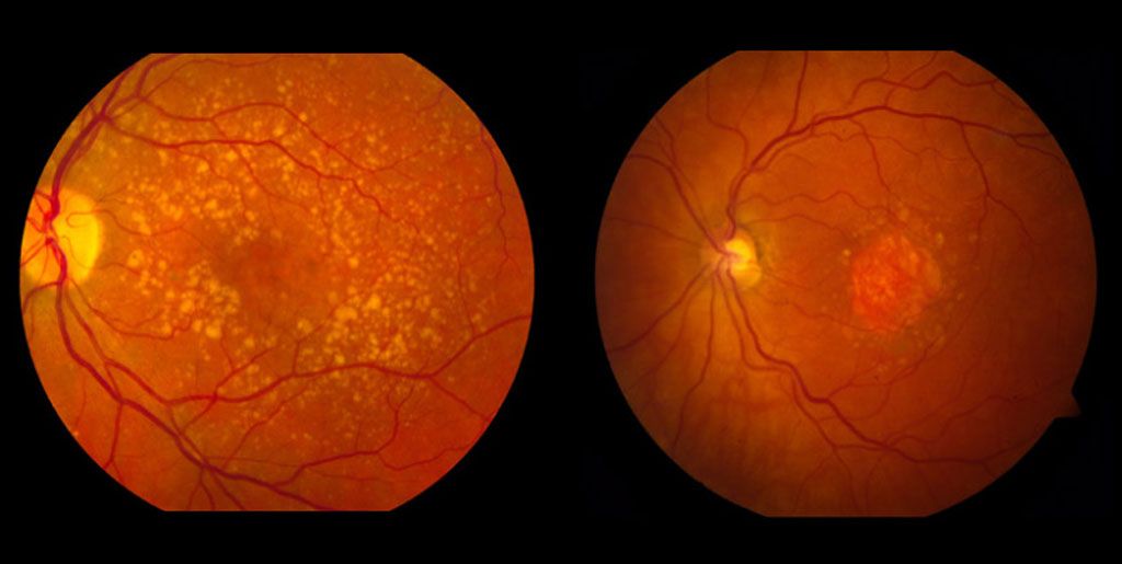 Wet AMD Gene Therapy Trial Demonstrates Consistent Safety and Efficacy ...