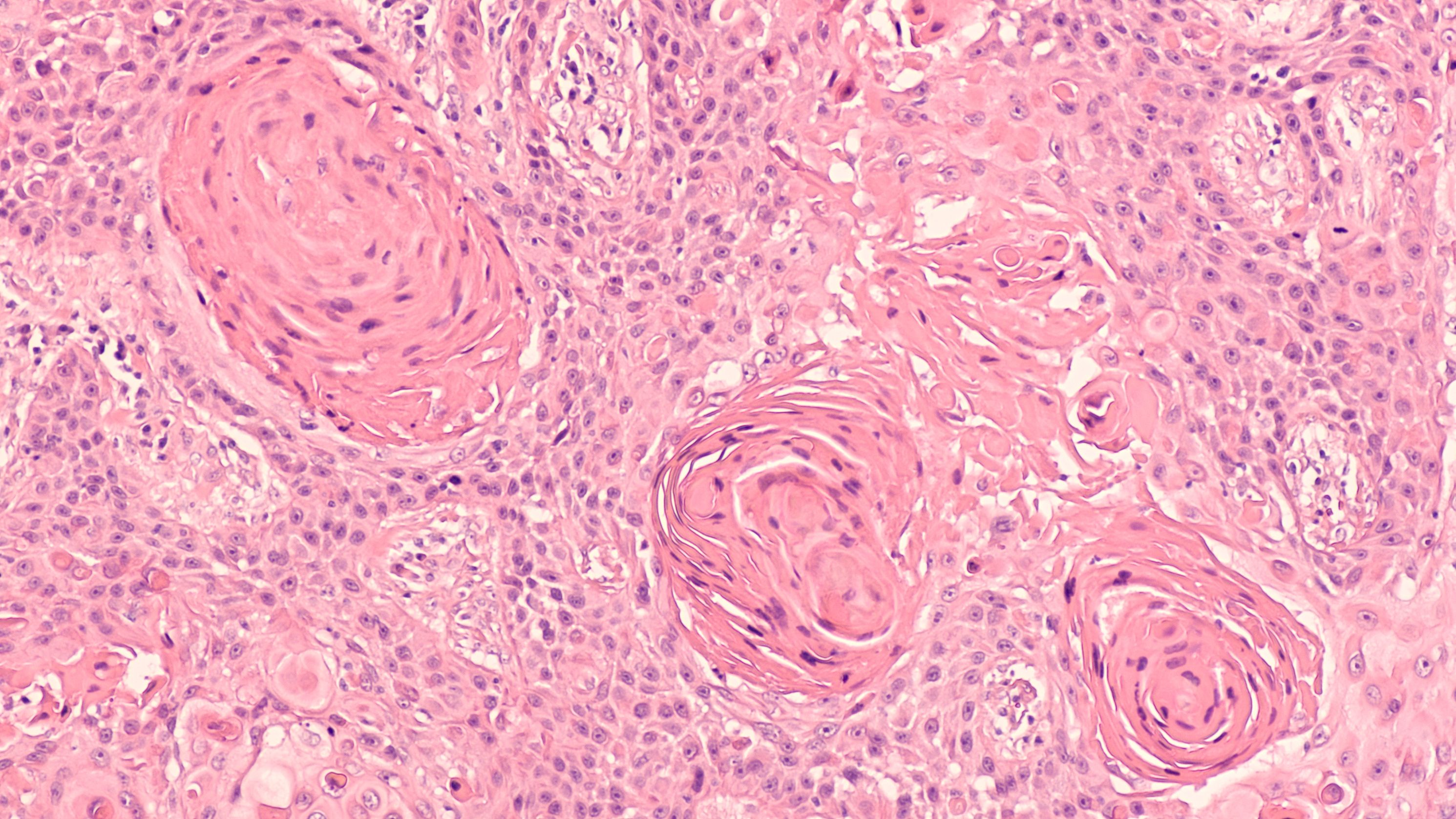New TIL Therapy to be Assessed in NSCLC New TIL Therapy to be Assessed in NSCLC