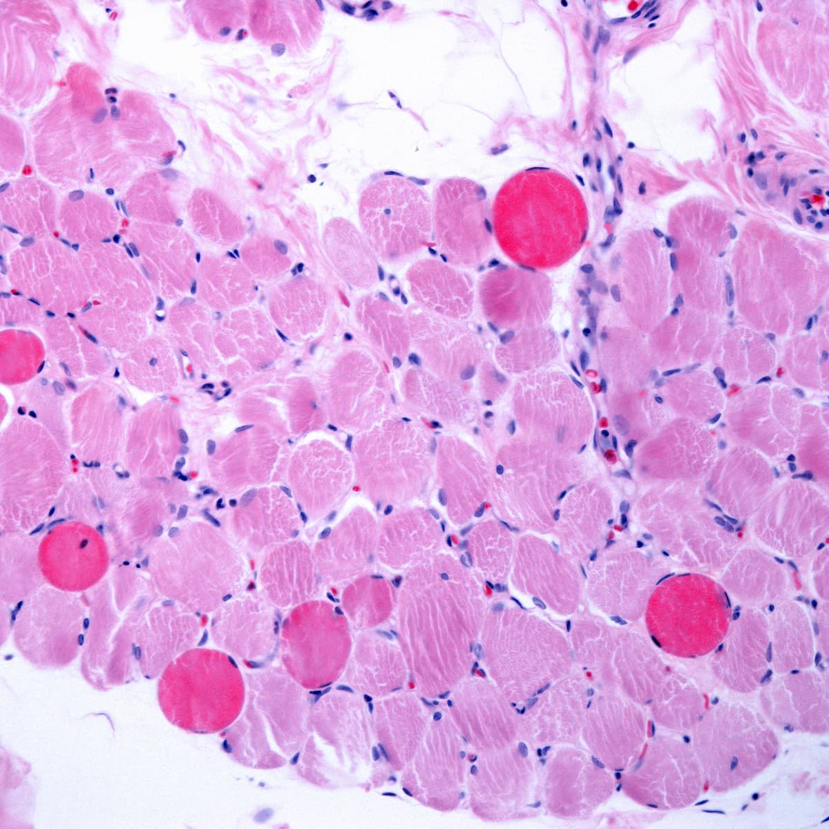 Genetic Medicine in DMD: End Points, Assessment, and Approvals