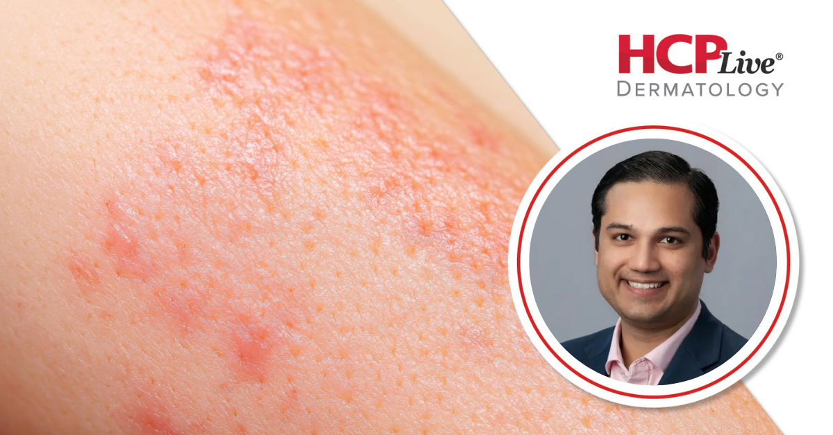 Highlighting PRIME Study Findings on Dupilumab for Prurigo Nodularis ...