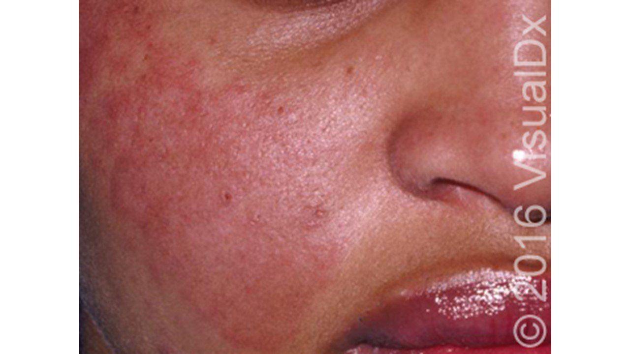 Image IQ: Erythema on Nose, Cheeks, Upper Back