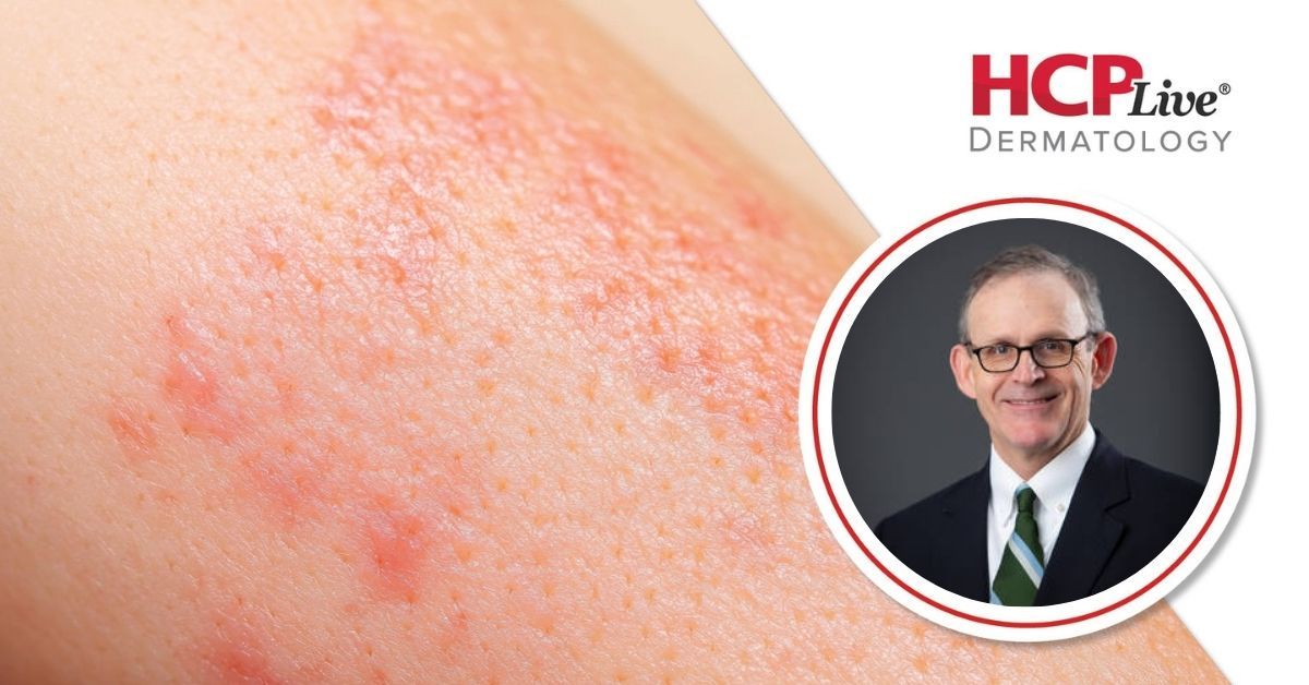 Going Deeper With Photodynamic Therapy for BCC, With M. Shane Chapman ...