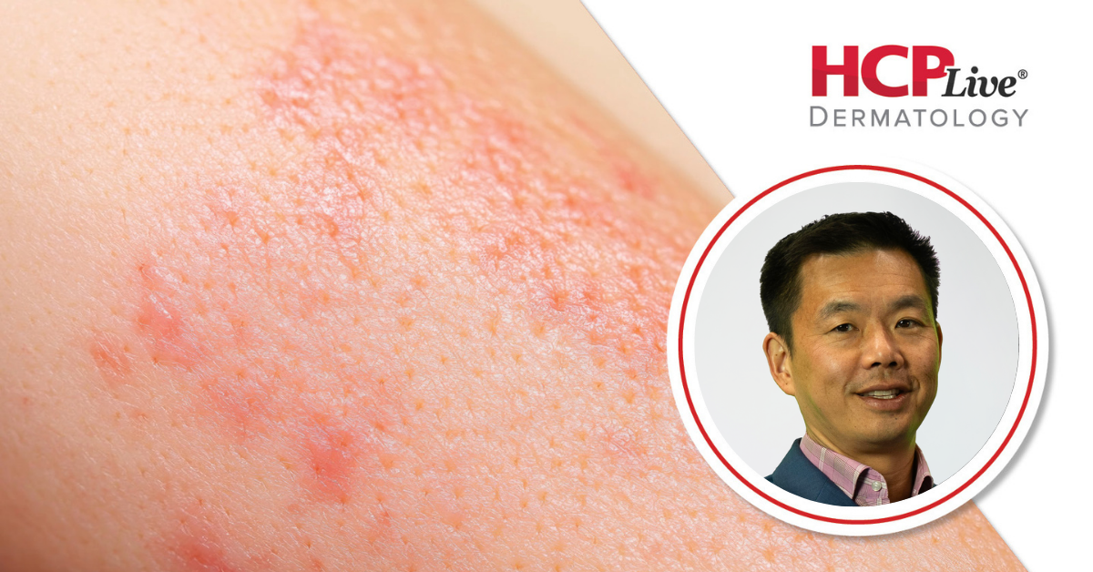 Discussing Phase 2b Findings on Temtokibart for Atopic Dermatitis, With ...