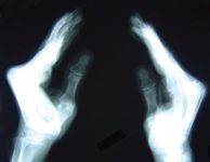 A 52-Year-Old Man With a Deforming Polyarthropathy