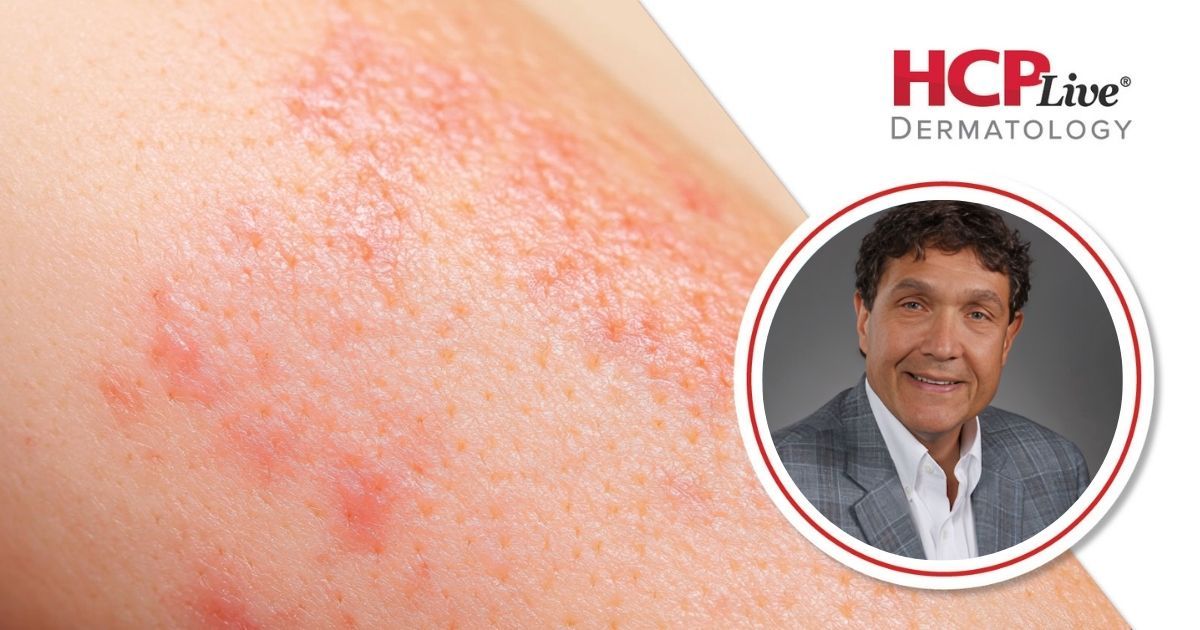 Povorcitinib 75 mg Rapidly Reduces Itch and Hives in CSU, With Jonathan ...
