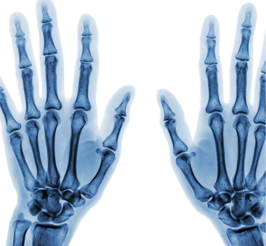 TNF Inhibitors May Reduce CVD Risk in Patients with Rheumatoid Arthritis TNF Inhibitors May Reduce CVD Risk in Patients with Rheumatoid Arthritis