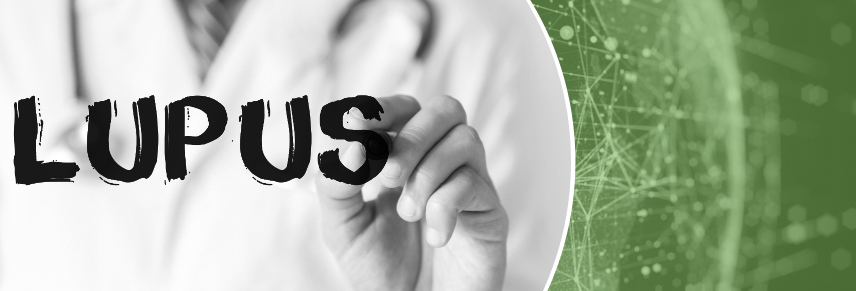 Trends in Long-Term Lupus Outcomes