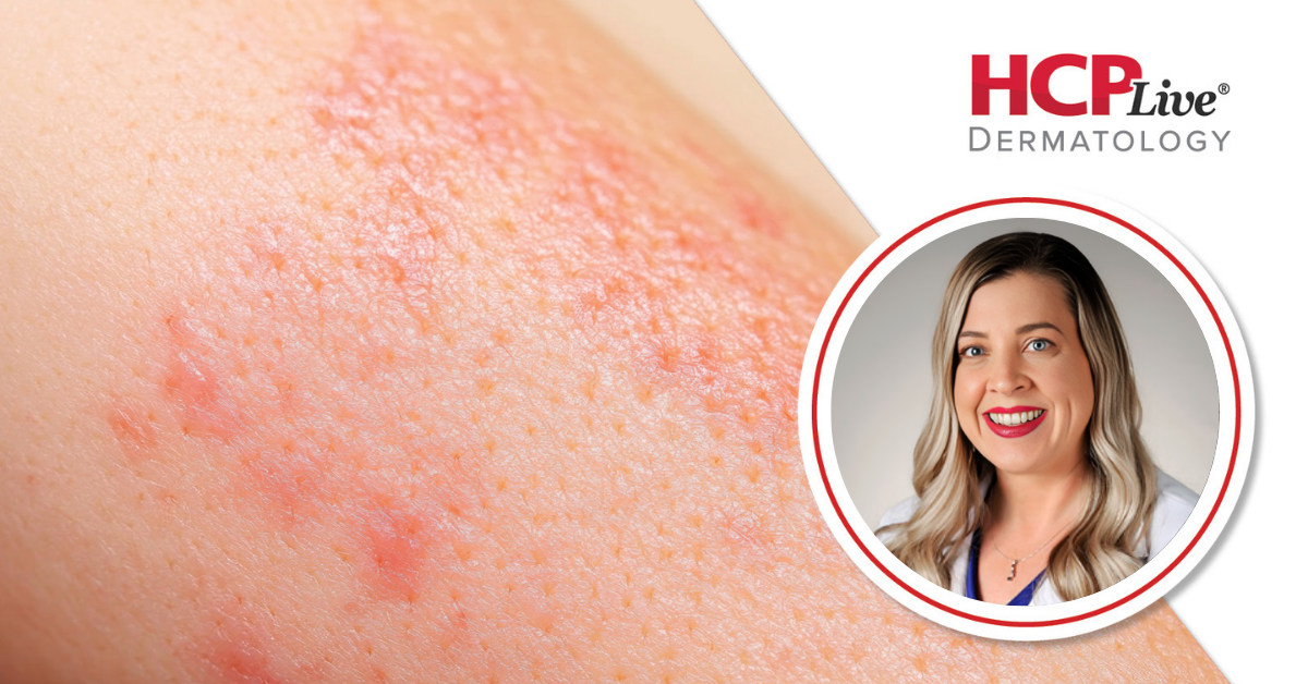 Tapinarof Cream 1% Improves Sleep in Atopic Dermatitis, With Druhan ...