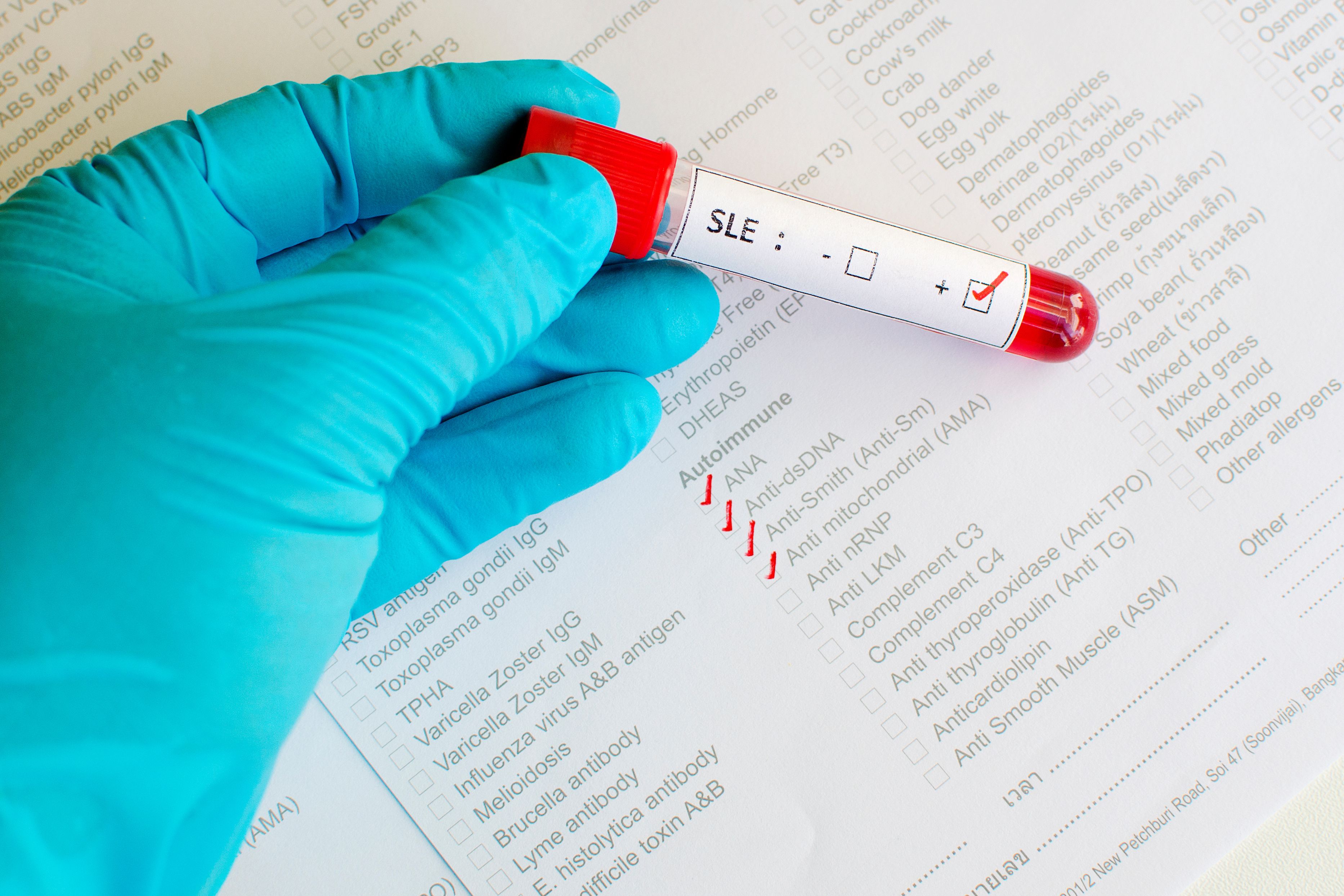 Iberdomide Proven Effective in Treating Patients With SLE