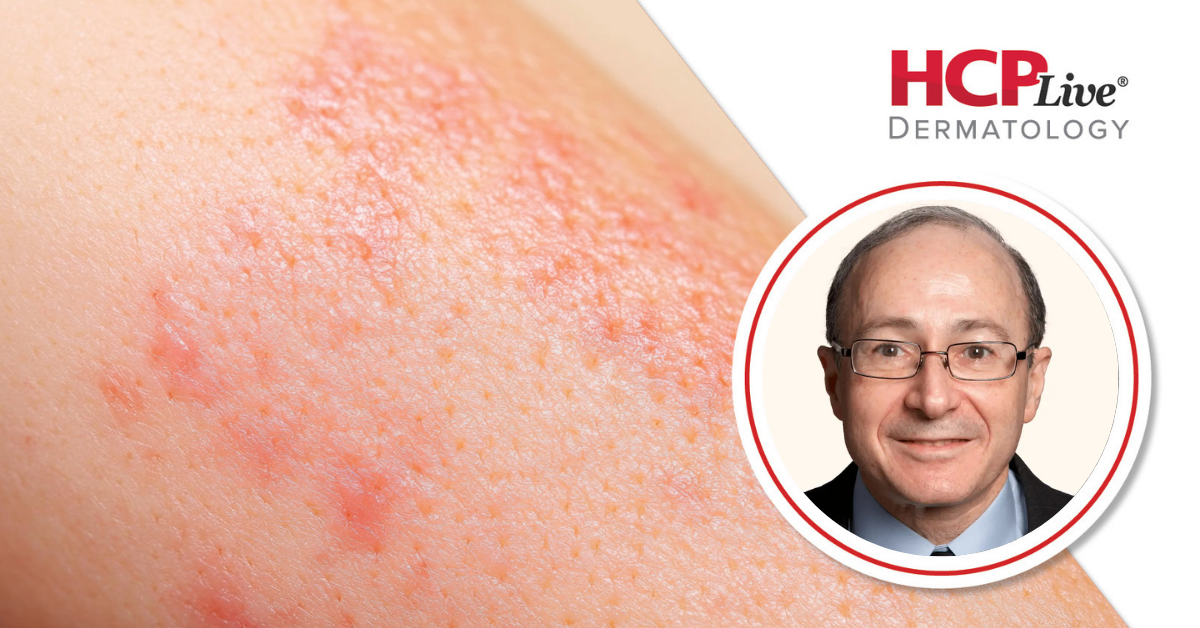 Phase 3b Data on Ixekizumab, Tirzepatide for Psoriasis and Overweight ...