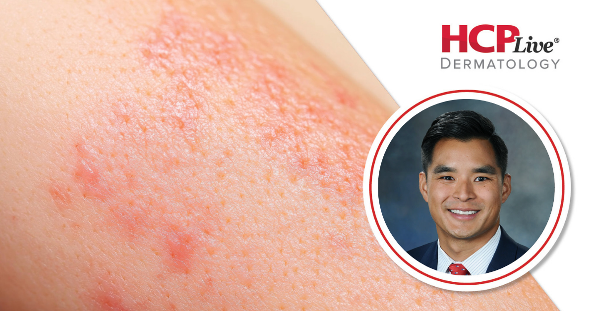 Immune Pathways Driving Chronic Spontaneous Urticaria, With Harrison ...