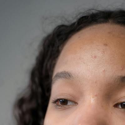 Patient-Reported Acne Assessment Tool Effective, Reliable in Evaluating ...