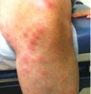Young Woman With Fever, Rash, Joint Pain, and Photophobia