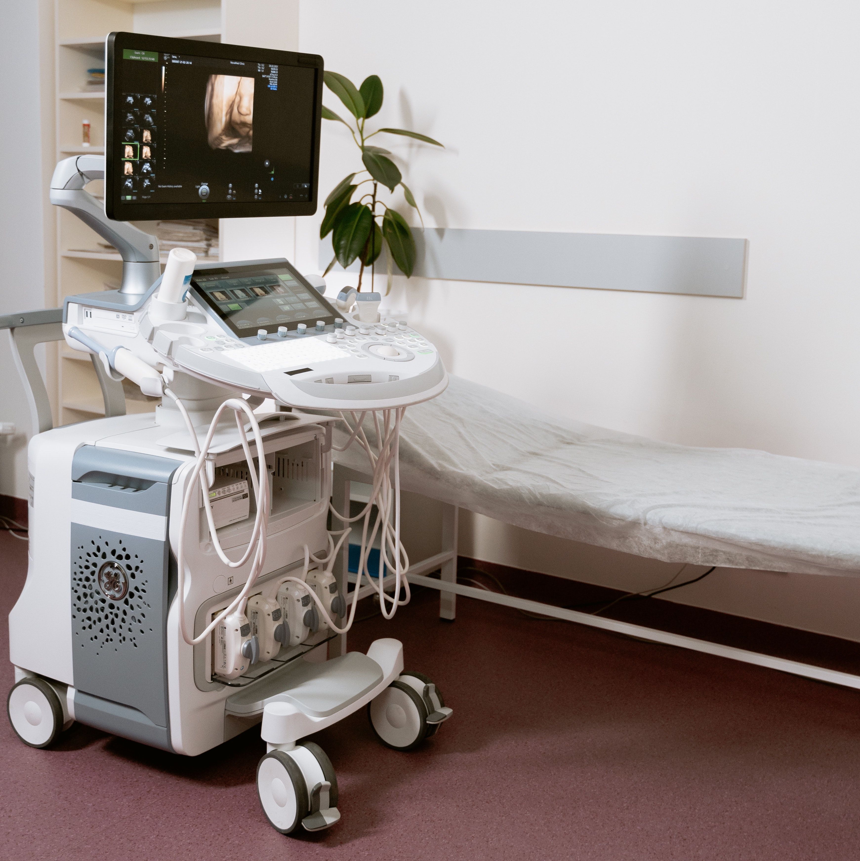 PAPP-A and the Presence of Uterine Fibroids During First Trimester in ...