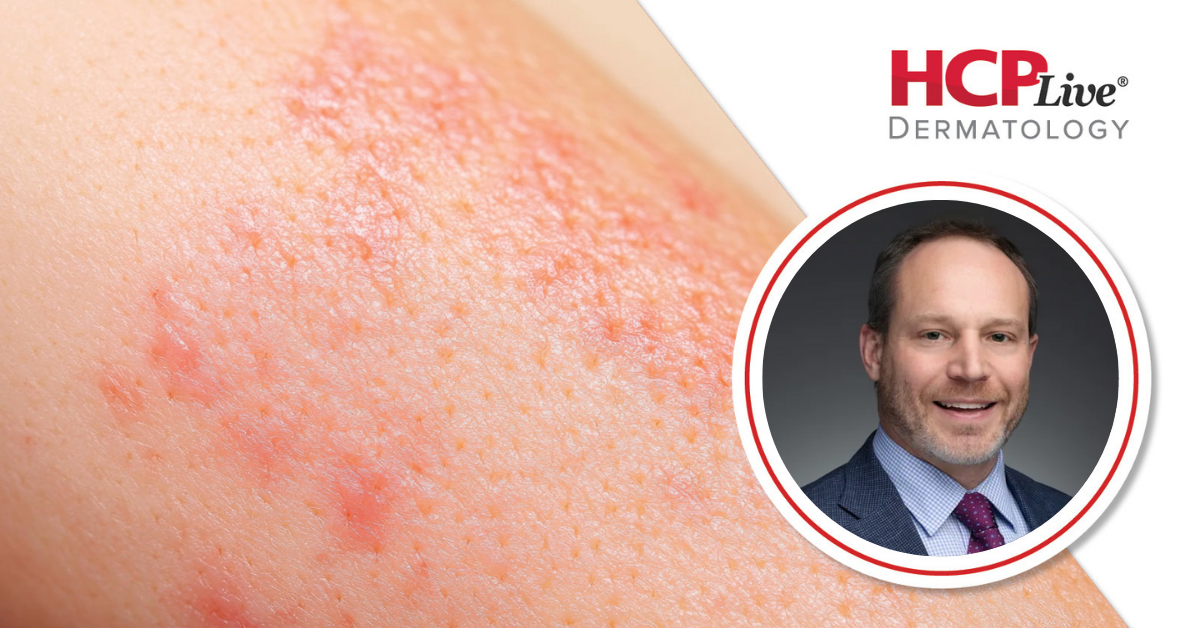 Cardiovascular Risk and Upadacitinib Treatment for Atopic Dermatitis ...