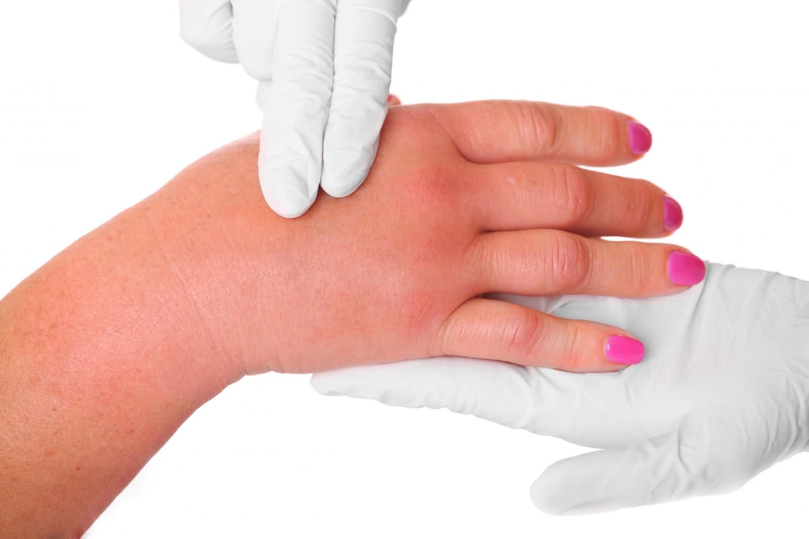 Berinert Treatment Proves Effective for Hereditary Angioedema