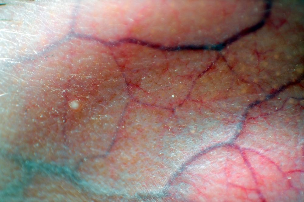 Diagnosing and Treating Vasculitis: an Update