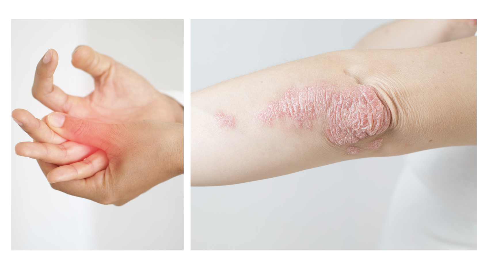 Long-Term Golimumab Treatment in Patients With Psoriatic Arthritis