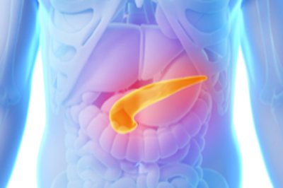 Treatment with Volanesorsen Shows Efficacy in Patients with FCS