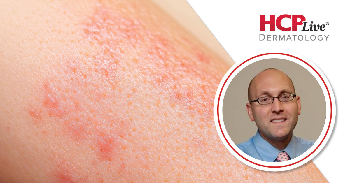 Discussing Current Treatment Options for Atopic Dermatitis, With Peter ...