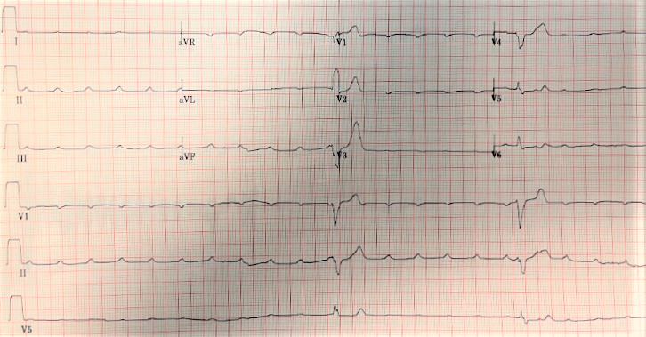 Cardiology Case Report: Bradycardia, Diaphoresis, & Syncope | HCPLive