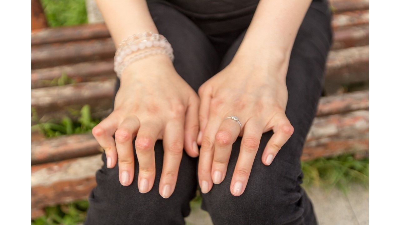 Clinical Quiz: What proportion of female RA patients use contraception?