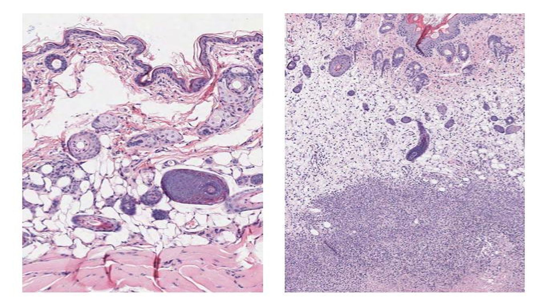 Two Group A Streptococcus Genes Linked to Flesh-Eating Bacterial ...