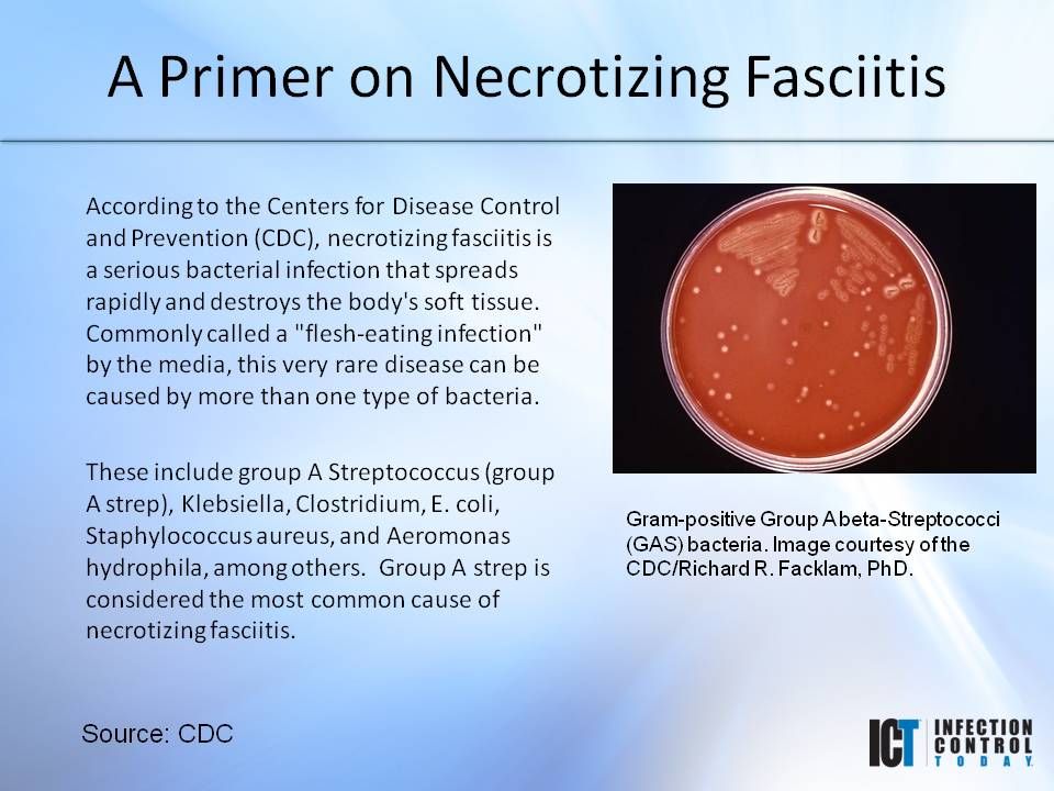 Slide Show: Primer on Necrotizing Fasciitis
