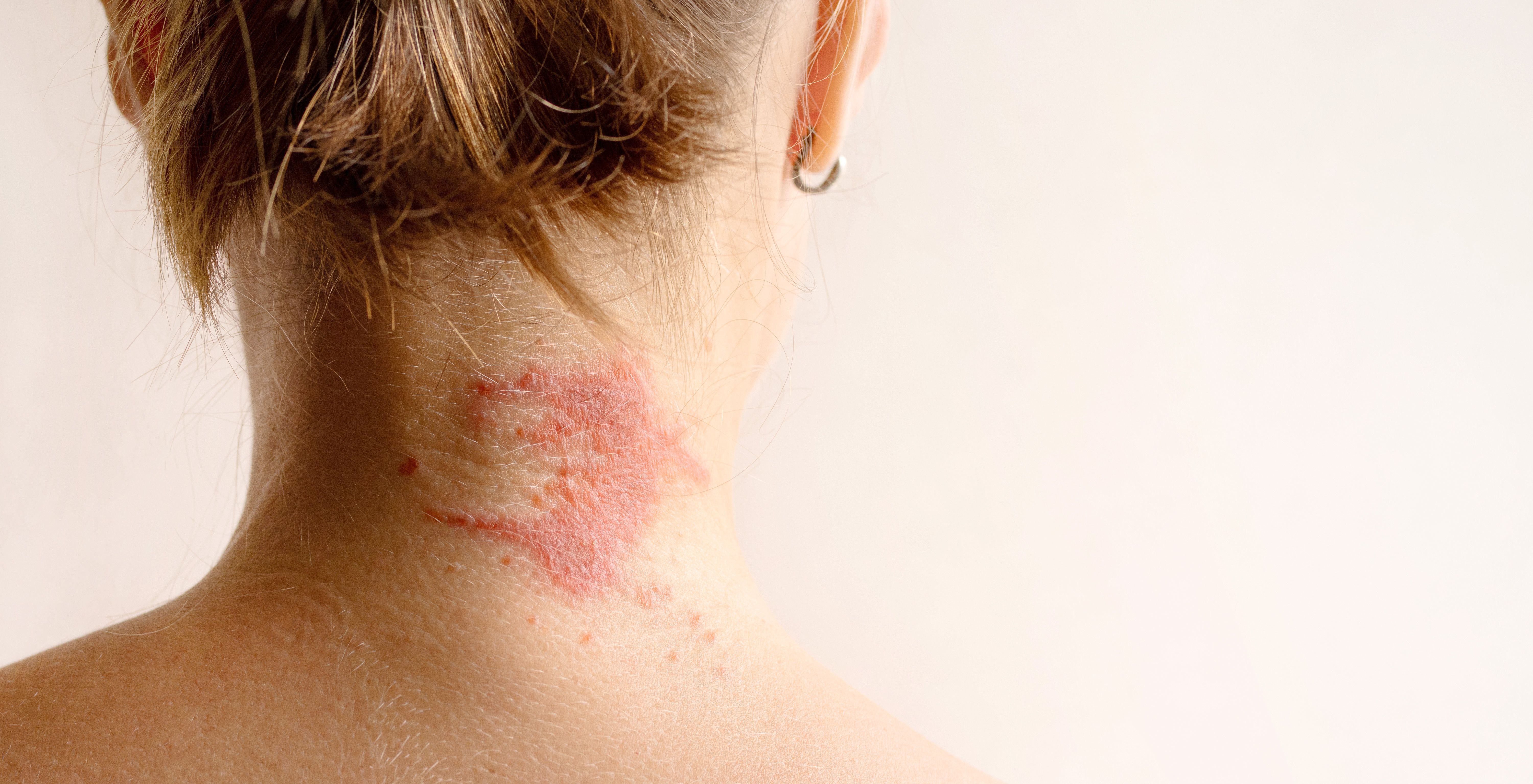 Atopic dermatitis patients report quality of life improvements with ...