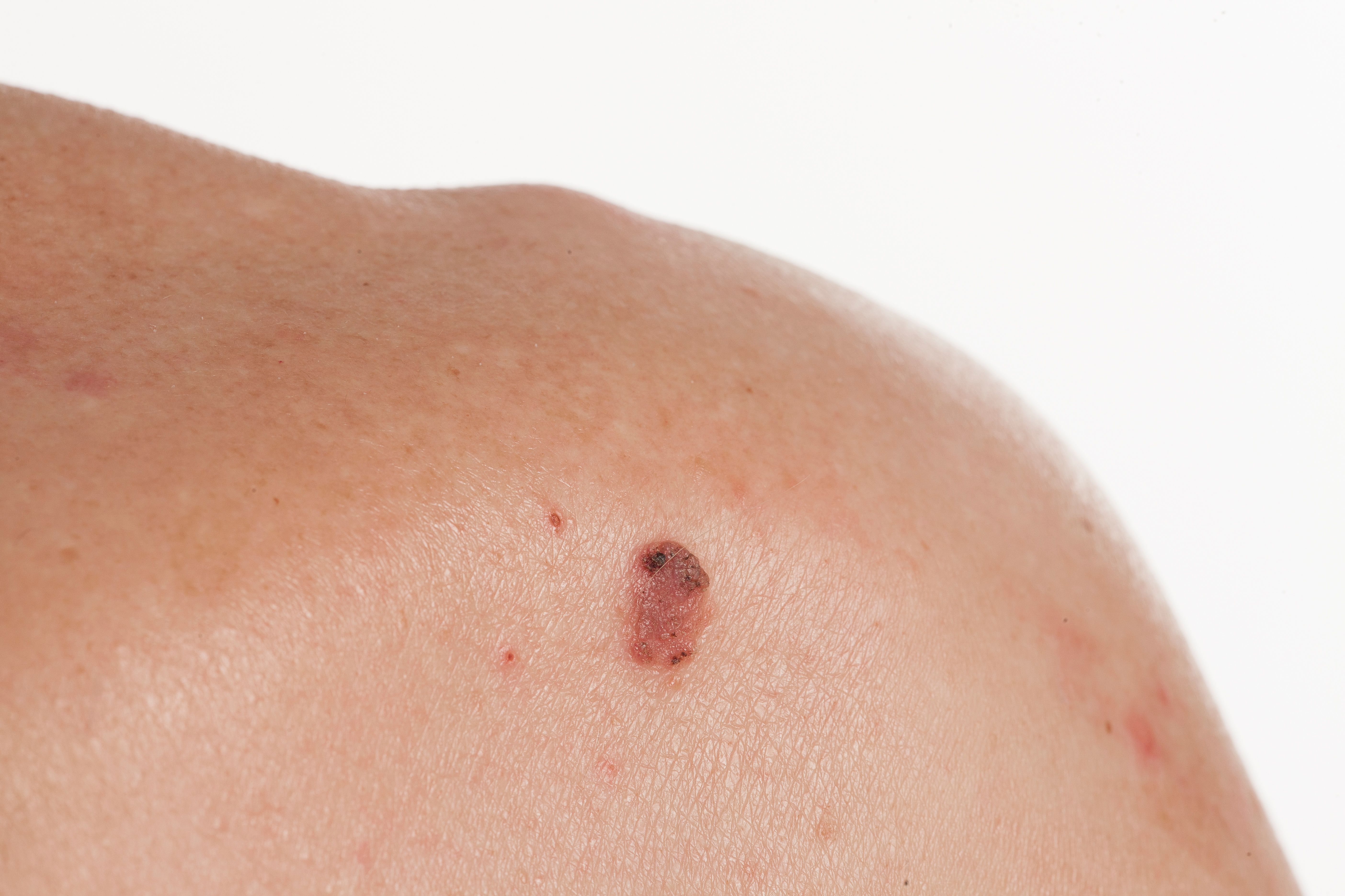 Positive Results for Libtayo as Adjuvant Treatment for Squamous Cell ...