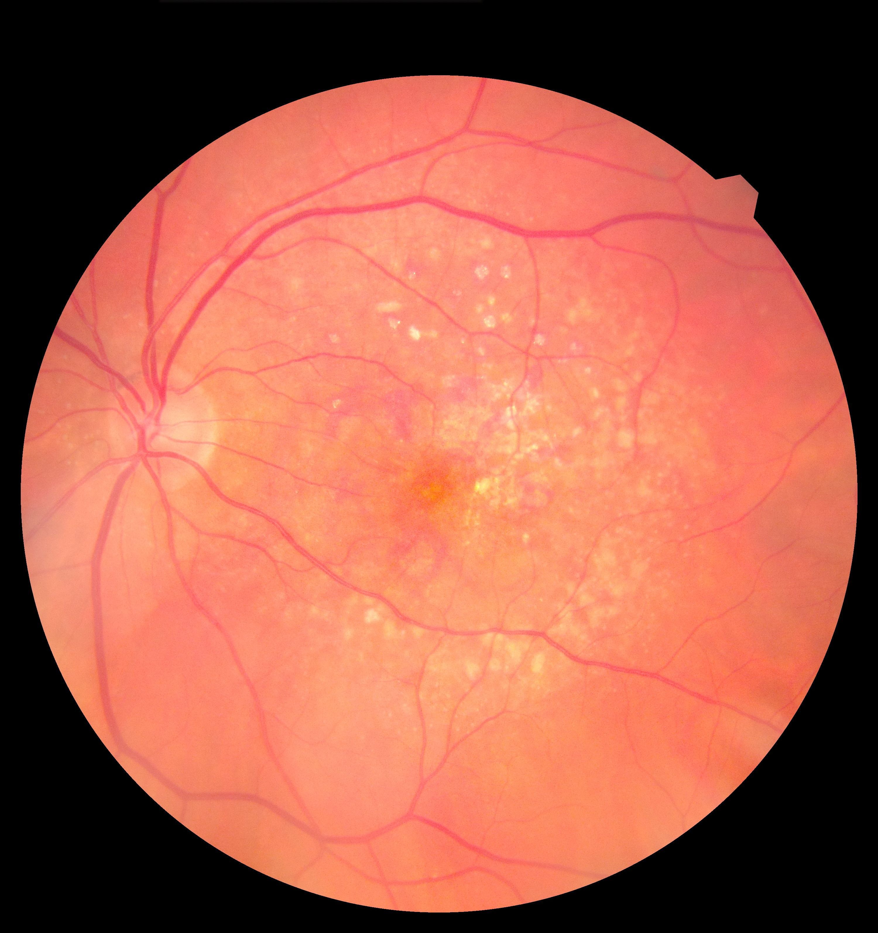 Updated: FDA Approves First Interchangeable Biosimilars to Eylea