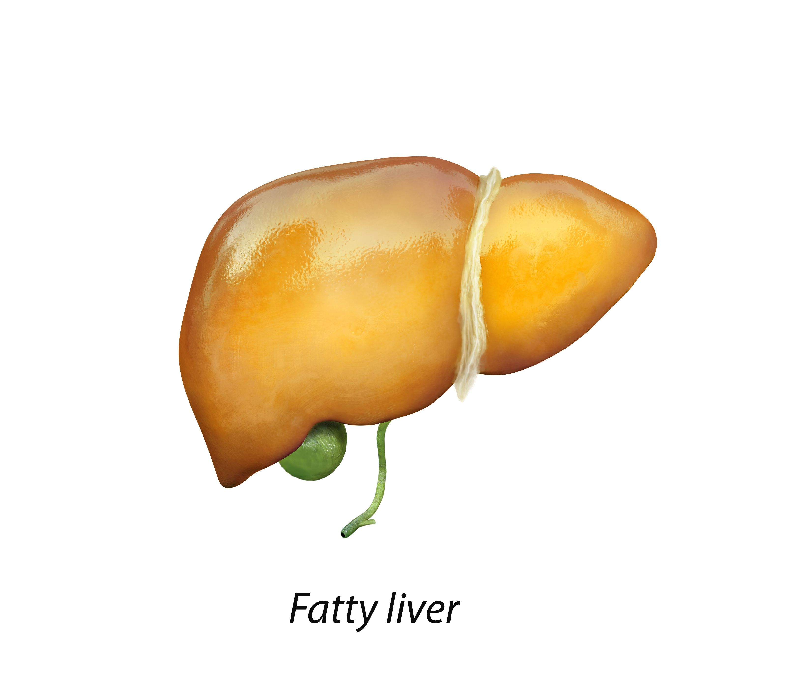 Positive Results for Resmetirom for Nonalcoholic Fatty Liver Disease Positive Results for Resmetirom for Nonalcoholic Fatty Liver Disease