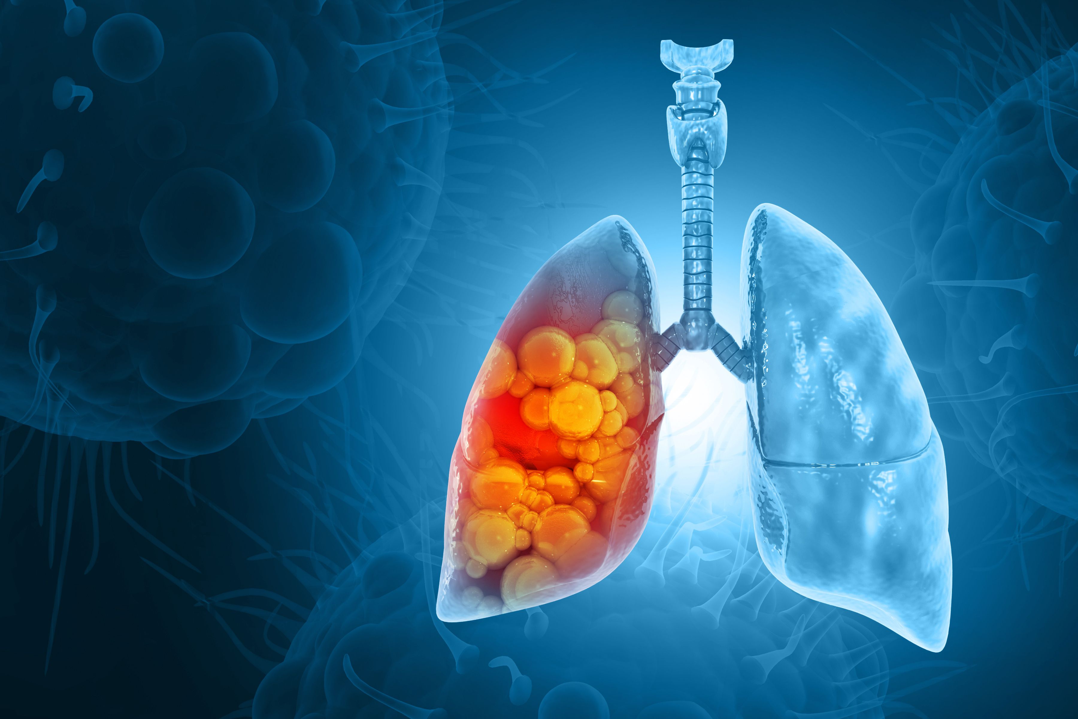 Trial Supports Bizengri as a Promising Treatment for NRG1 Fusion ...