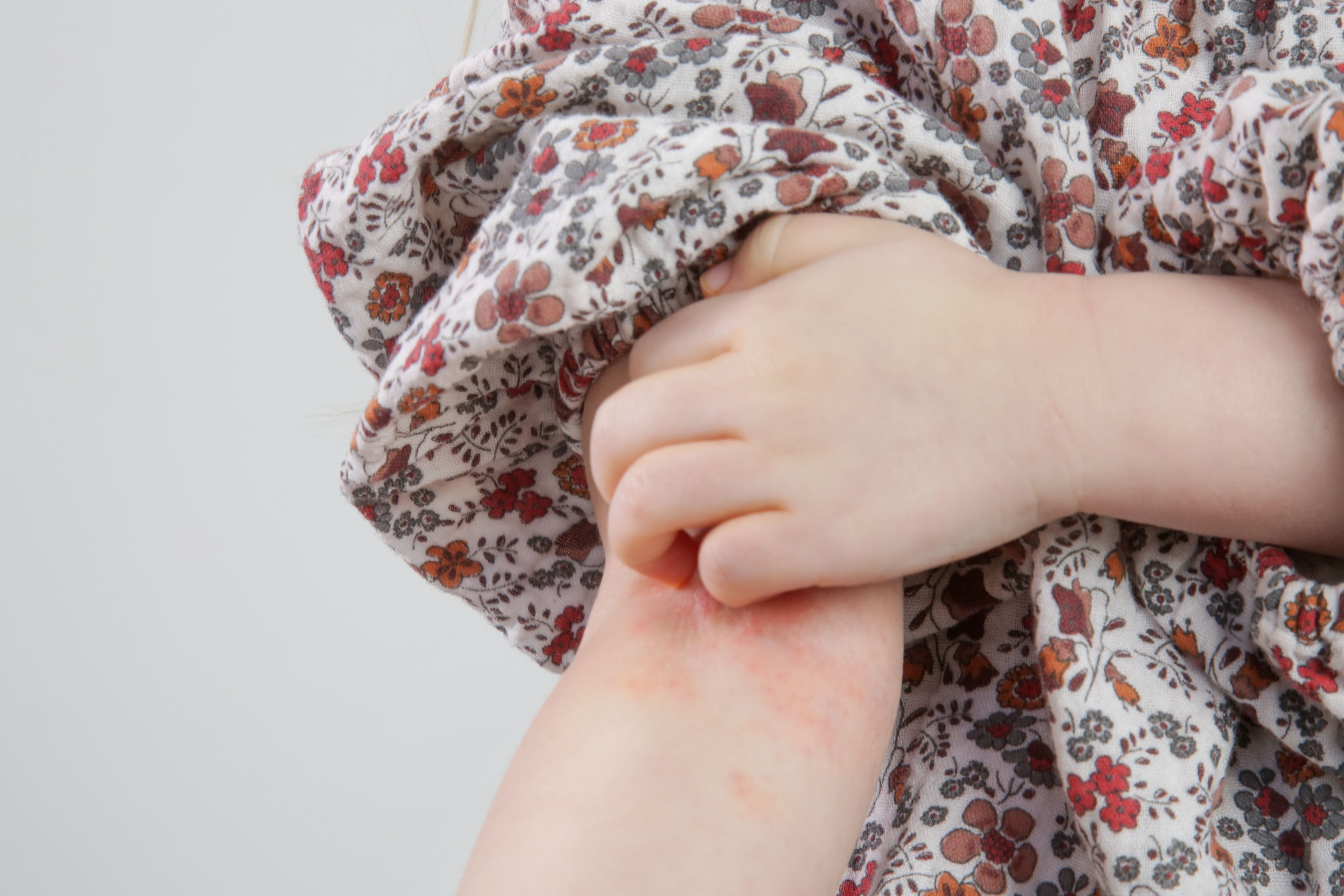Atopic Dermatitis and Allergic Contact Dermatitis Overlap in Children ...