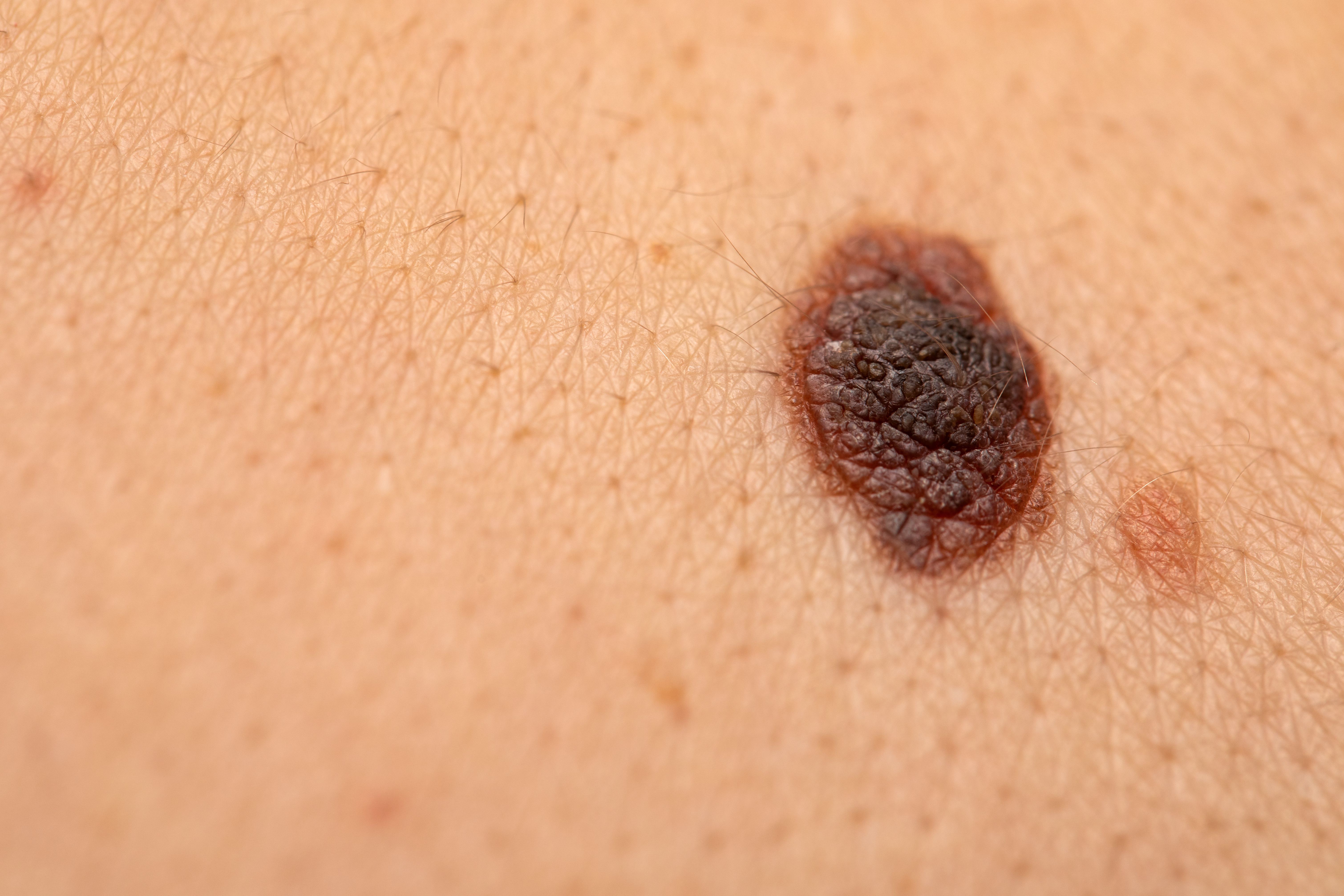 Early Trial of Libtayo Combination Demonstrates Activity in Melanoma