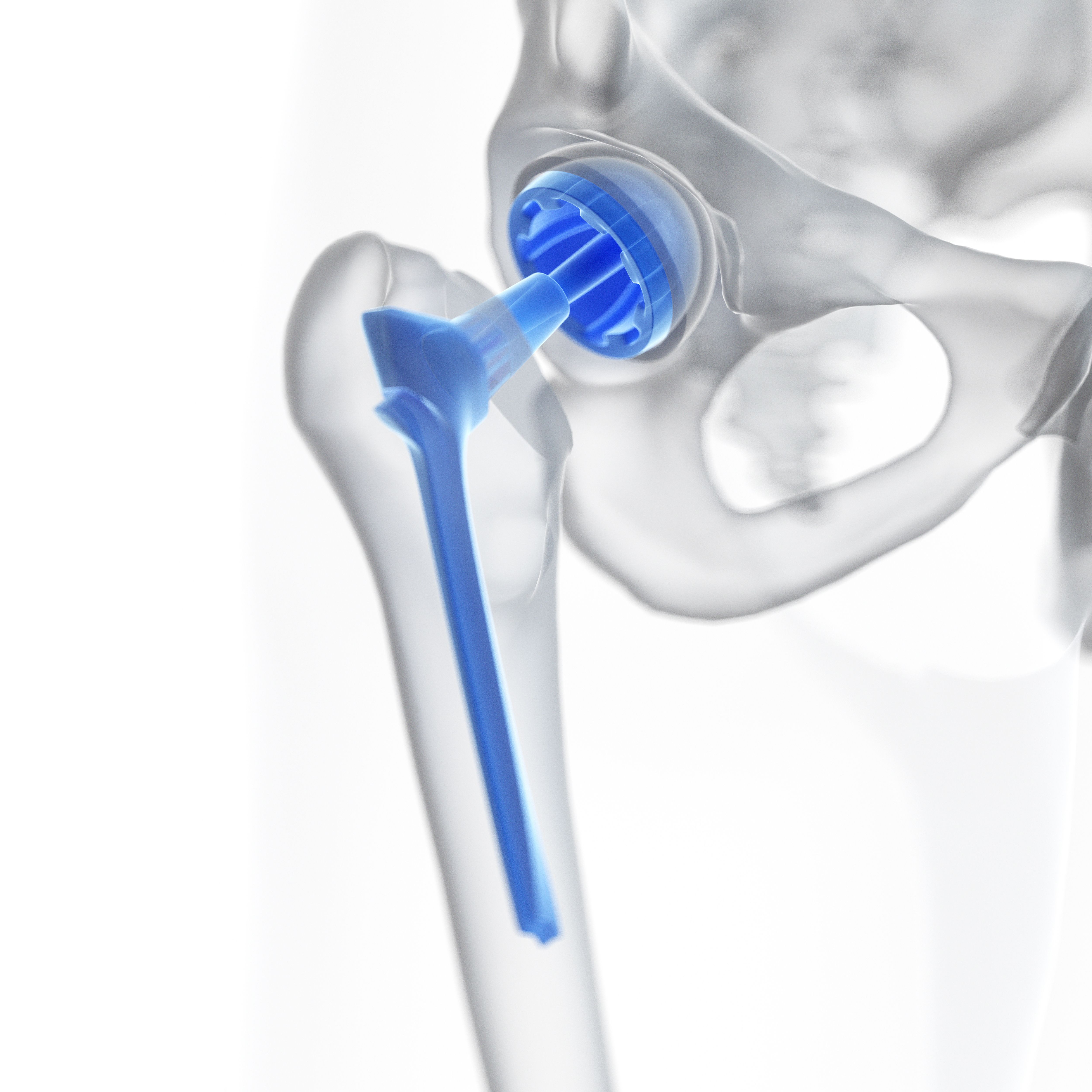 Contact Dermatitis Can Be a Complication of Metal Implants | Managed ...