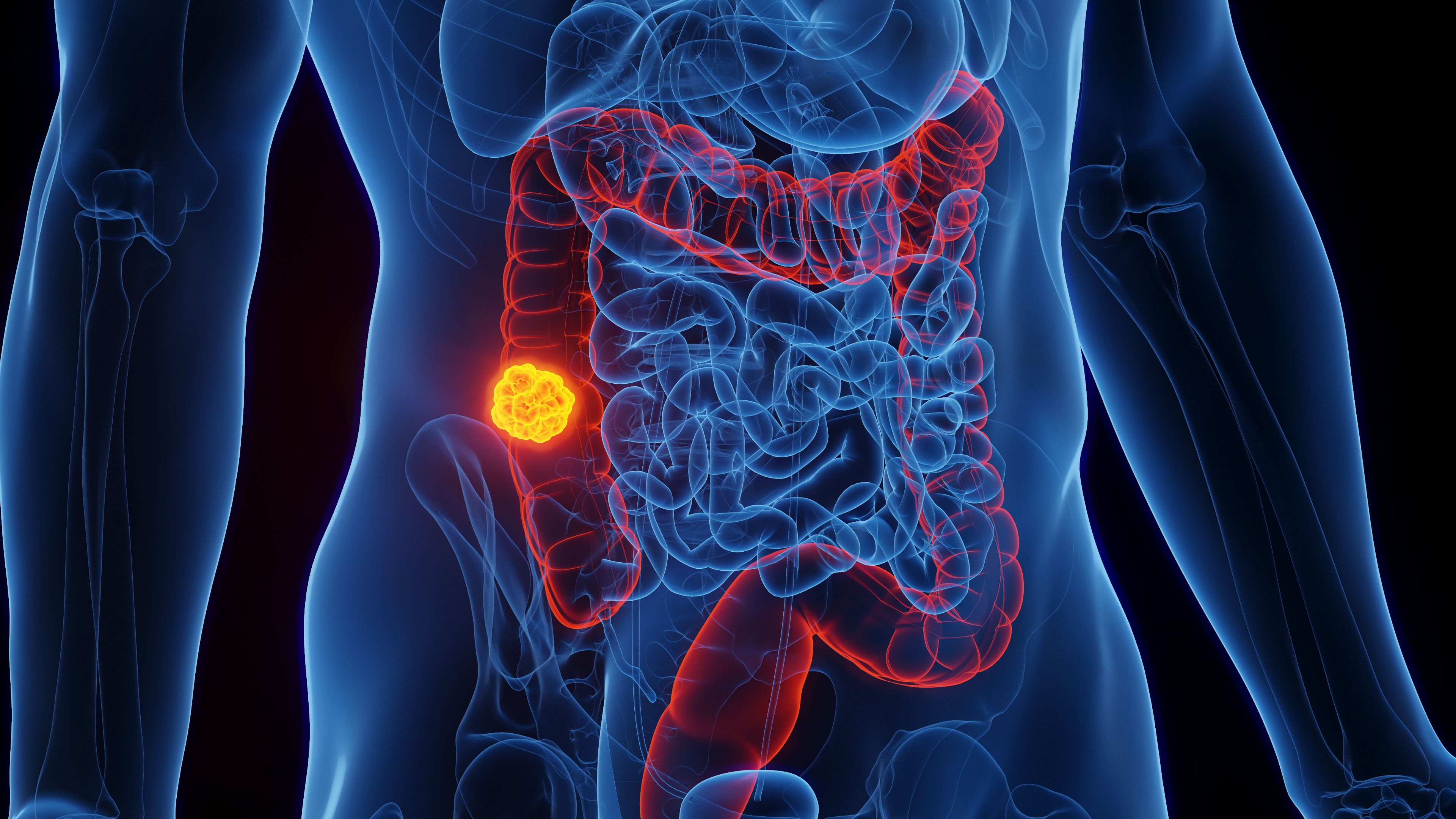 ctDNA may identify stage III colon cancer patients who benefit from ...