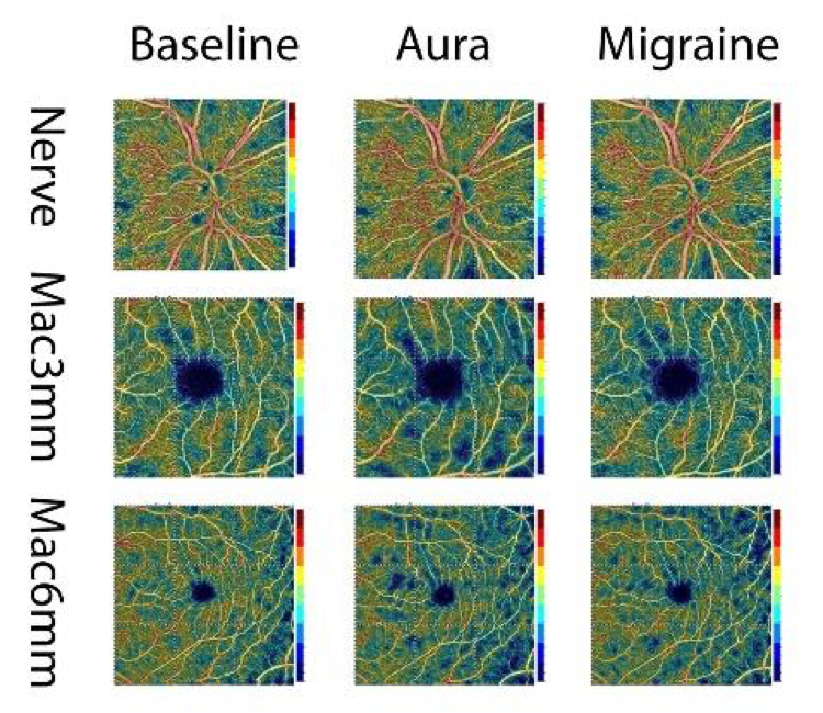 Migraines and retinal perfusion: A headache for physicians, patients ...