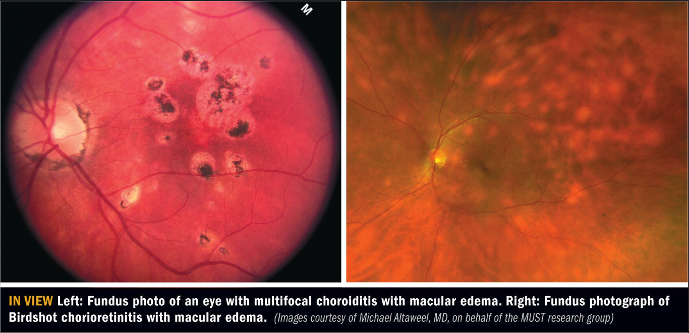 Managing uveitic macular edema | Modern Retina