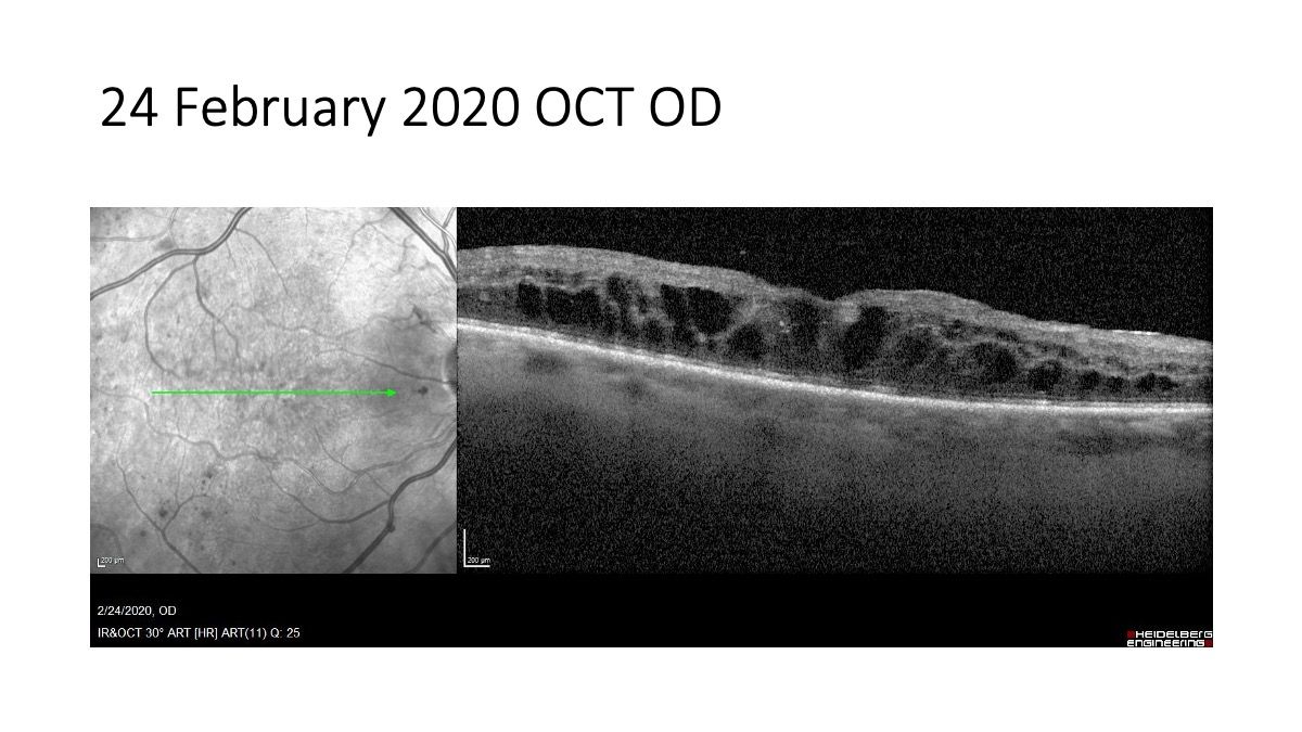 Managing diabetic eye disease eased with repeatable, high-quality imaging