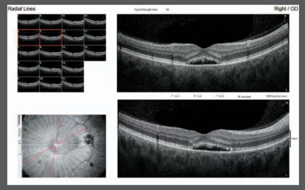 Laser therapy may offer fast-acting option for CSR resolution