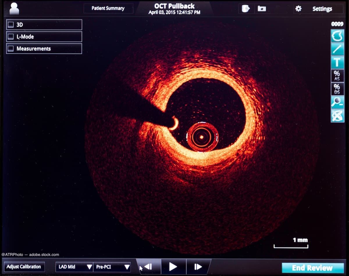 Consensus clinical trial design for the treatment of intermediate AMD ...