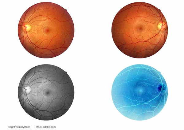 Q&A: Evolving approaches to geographic atrophy management | Modern Retina