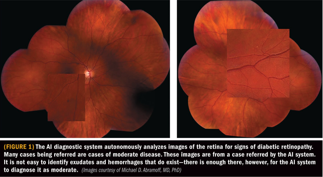 Applying AI in fundus images | Modern Retina